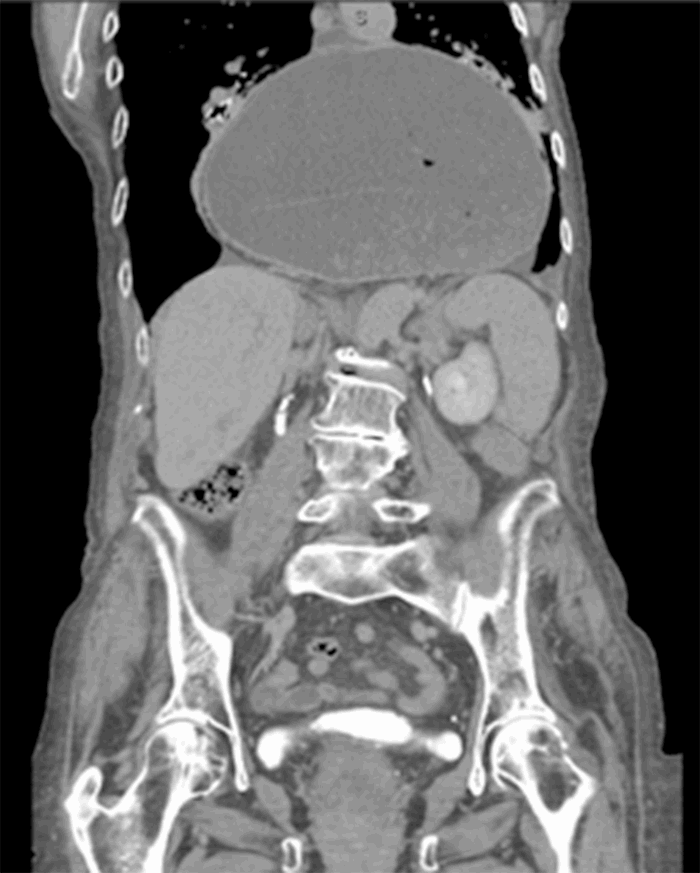 Endoscopic Management of a Type III Paraesophageal Hernia Causing ...