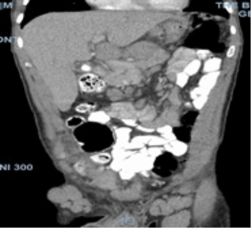 Acute Tip Appendicitis in the Setting of Newly Diagnosed Adult T-Cell ...
