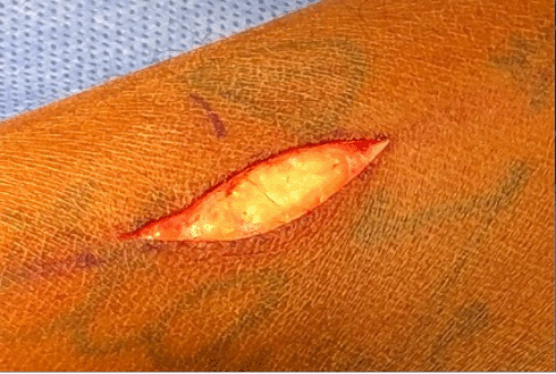 A Better Incision: The Best of Both Worlds | ACS