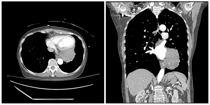 Cardiac Schwannoma Arising from the Atrioventricular Groove | ACS
