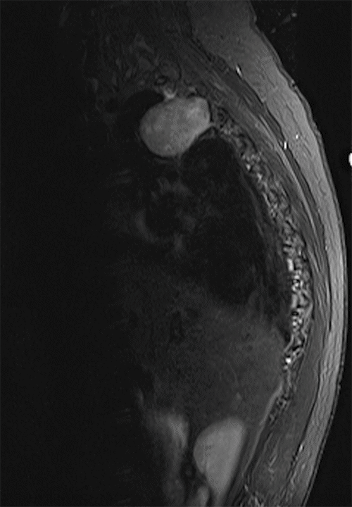 Decades Old: A Paraspinal Tumor with Intrathoracic Extension and ...