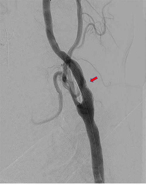 Binocular Amaurosis Fugax Treated with Staged Bilateral Transcarotid ...