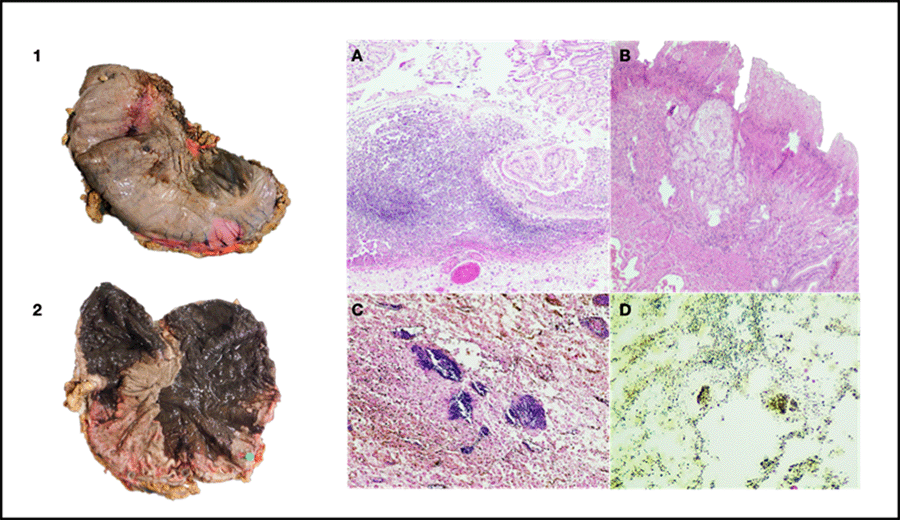 A Rare Cause of Gastric Necrosis Treated With Total Gastrectomy and ...