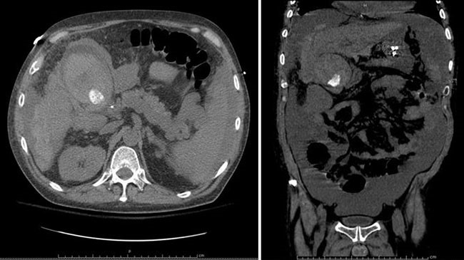 A Rare Case of Necrotizing Streptococcal Myositis of the Chest and ...