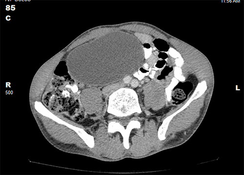 Adenocarcinoma of the Sigmoid Colon as a Lead Point for Colocolic ...