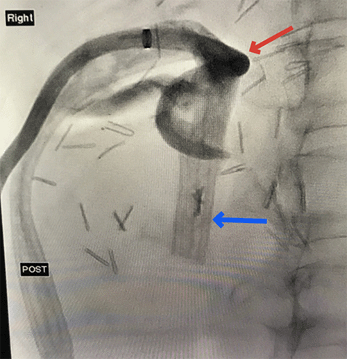 Endoscopic Ultrasound-Guided Drainage of a Complex Subphrenic ...