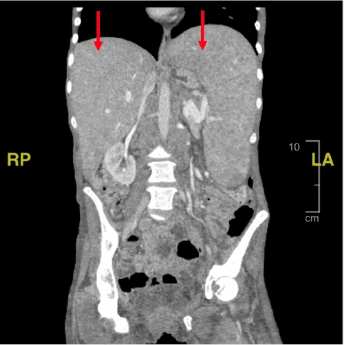 Disseminated Mycobacterium avium-Intracellular Complex in an HIV ...