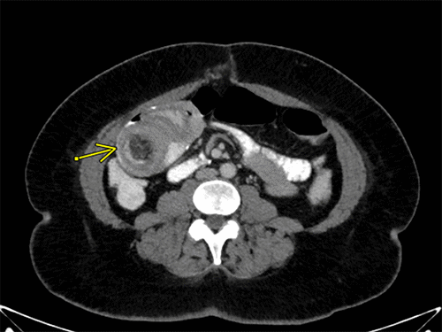 Recurrent Retrograde Intussusception Despite Revision of Jejunojejunal ...