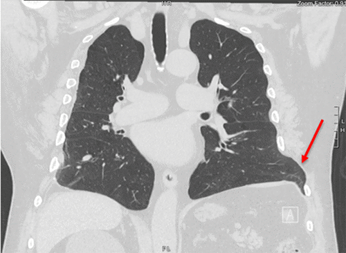 Intercostal Hernia and Costochondral Disruption Repair | ACS