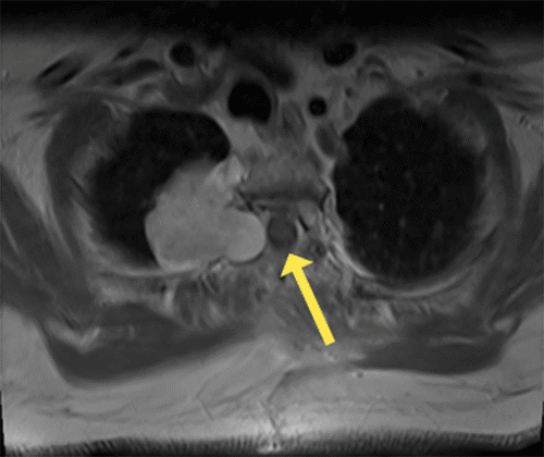 Decades Old: A Paraspinal Tumor with Intrathoracic Extension and ...