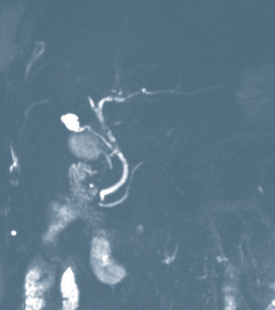 Conversations in Acute Cholecystitis Management Include Treatment ...