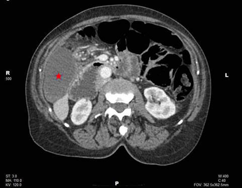 Gallbladder Volvulus: A Rare Entity | ACS