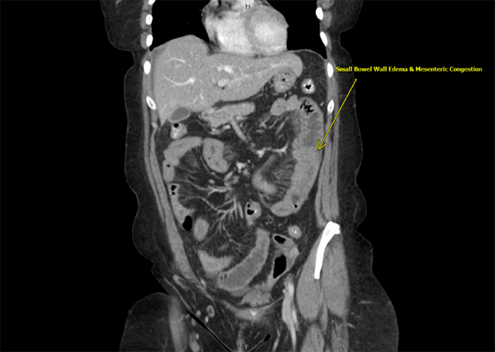 Gastrointestinal Manifestations of COVID-19 Mimicking a Surgical ...