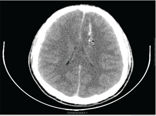 A Systematic Review of Neurogenic Pulmonary Edema in Traumatic Brain ...