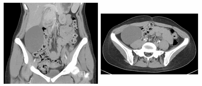 Retroperitoneal Masses Radiology CT And MR Imaging Of Retroperitoneal