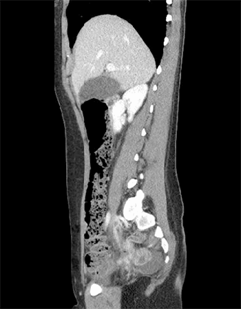Rare Care of Retrorectal Abscess and Meningocele | ACS