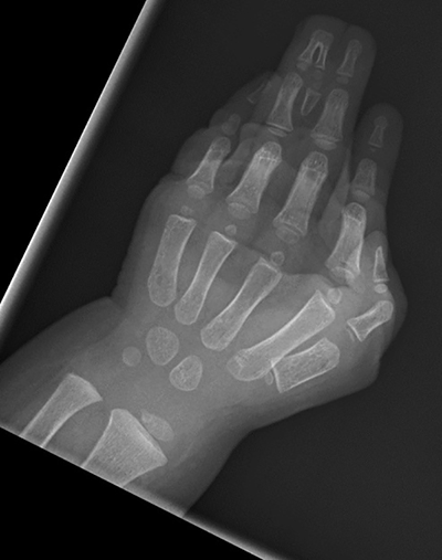 Syndactyly Repair with a Straight-Line Technique: A Case Series | ACS
