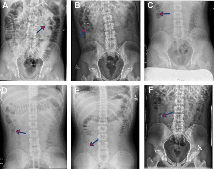 Stick a Pin in It: Amyand Revisited | ACS