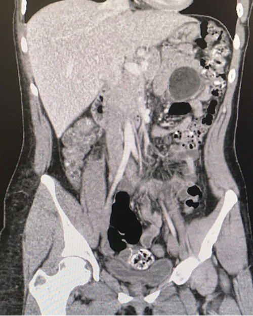 Small Bowel Mesenteric Mass: A Rare Mystery | ACS