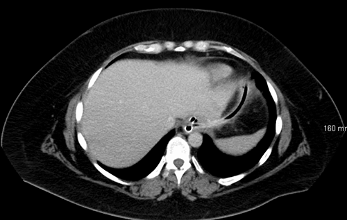 A Minimally Invasive Approach to Persistent Gastric Staple-Line Failure ...