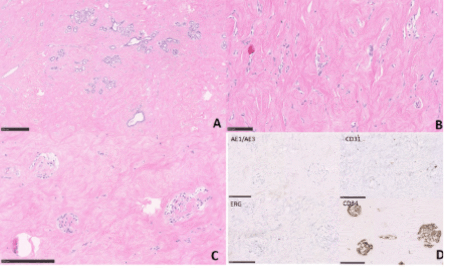 Unique Presentation of Pseudoangiomatous Stromal Hyperplasia | ACS