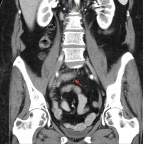 Perforated Appendiceal Diverticulitis Mimicking Appendicitis | ACS