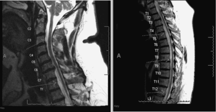 Delayed Presentation of a Ventral Cervical Pseudomeningocele Resulting ...
