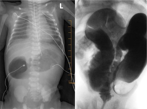 Concomitant Duodenal Atresia and Hirschsprung Disease | ACS