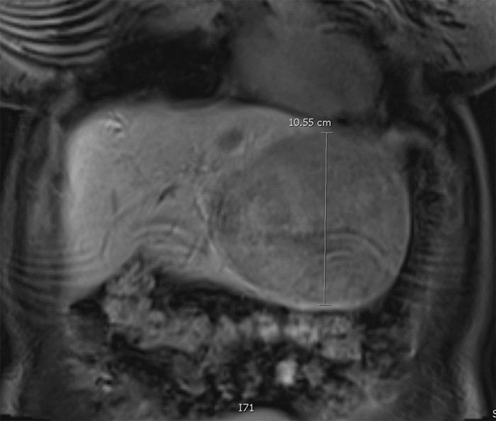 Giant Mixed Beta Catenin-Inflammatory Hepatic Adenoma | ACS
