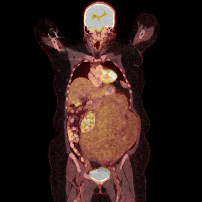 Polycythemia in a Patient with a Large Retroperitoneal Leiomyoma | ACS