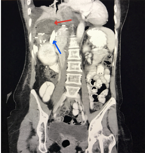 Endoscopic Ultrasound-Guided Drainage of a Complex Subphrenic ...