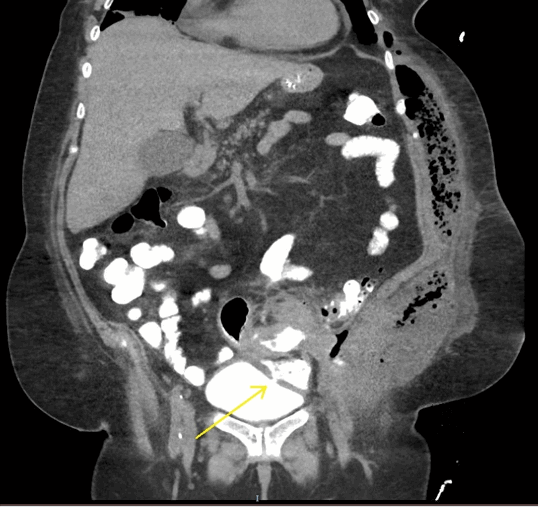 A Rare Case of Sigmoid Adenocarcinoma Presenting with Coloenteric ...
