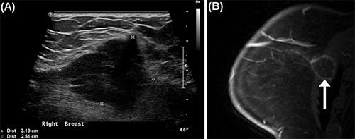 Nodular Fasciitis of the Pectoralis Muscle in a 54-Year-Old Woman | ACS