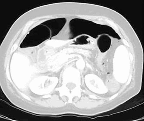 Postpartum Bowel Perforation after Normal Vaginal Delivery without ...