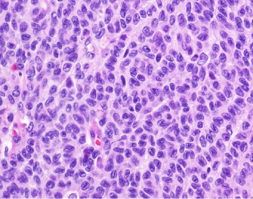 A Large Extraovarian Granulosa Cell Tumor of the Retroperitoneal Space ...