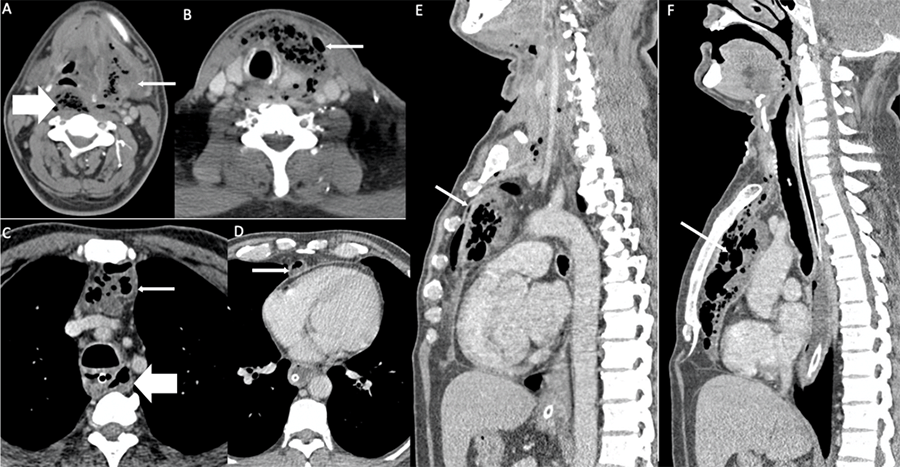 Descending Necrotizing Mediastinitis: A Surgical Challenge Managed ...