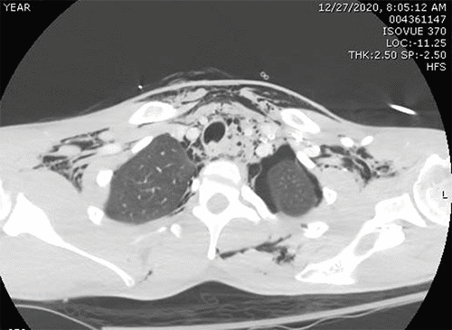 Repeat Thoracic Duct Embolization in Traumatic Thoracic Duct Injury: An ...