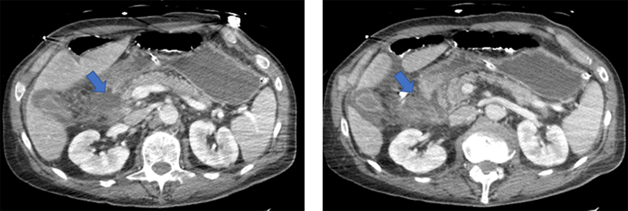 Delayed Presentation of a Duodenal Perforation After Blunt Abdominal ...
