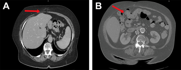 Posterior Rectus Sheath Hernia | ACS