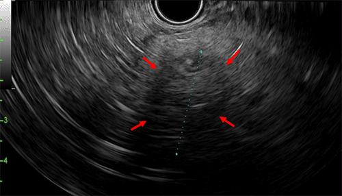 Pancreatic Tophaceous Gout Masquerading as a Pancreatic Tail Mass | ACS