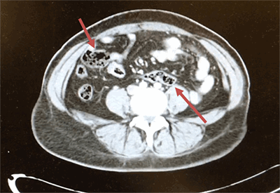 48-Year-Old Female Presents with Intestinal Malrotation and Acute ...