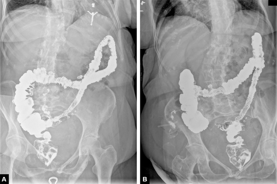 Colosalpingeal Fistula Resulting from Acute Complicated Diverticulitis ...