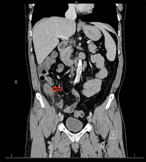 Signet Ring Cell Carcinoma of the Breast: An Aggressive Tumor | ACS