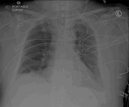 Elevated Diaphragm Lung Chest X Ray Showing An Elevated Right