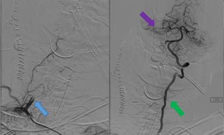 Retained Bullet in the Spinal Canal and Vertebral Artery Transection | ACS