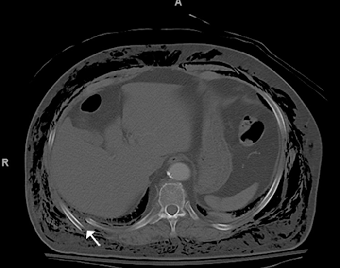 Traumatic Lung Herniation, Repair With Rib Fixation | ACS