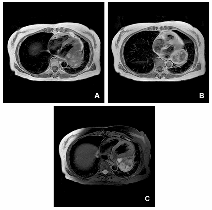 Cardiac Schwannoma Arising from the Atrioventricular Groove | ACS