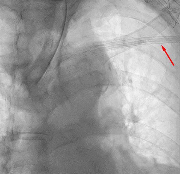 Management Strategies for Totally Implantable Venous Access Devices Not ...