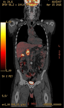 High-Grade Neuroendocrine Carcinoma of the Gallbladder Presenting as ...