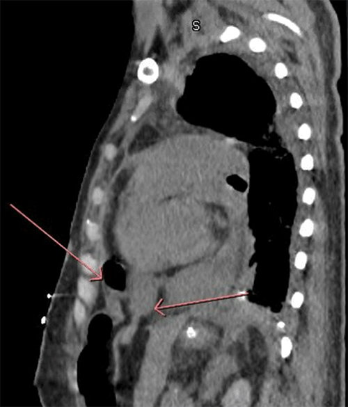 Parietopericardial Hernia with Small Bowel Strangulation ...